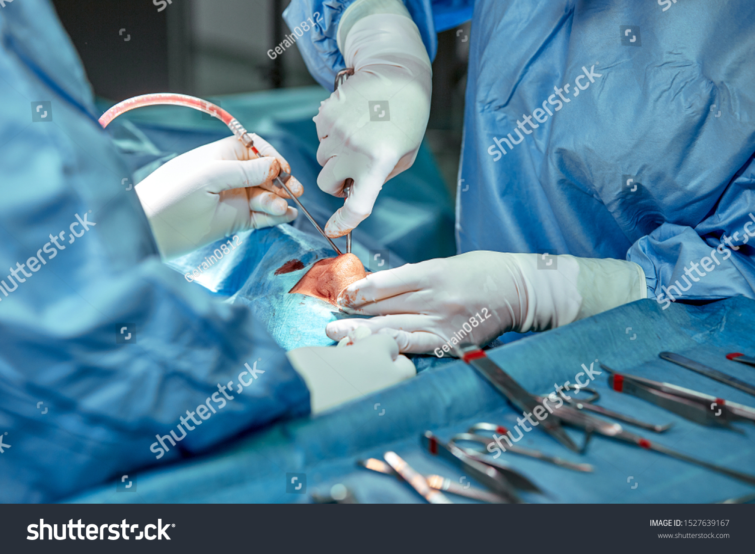 Rhinoplasty close-up. A real operation a team of surgeons performs an ...