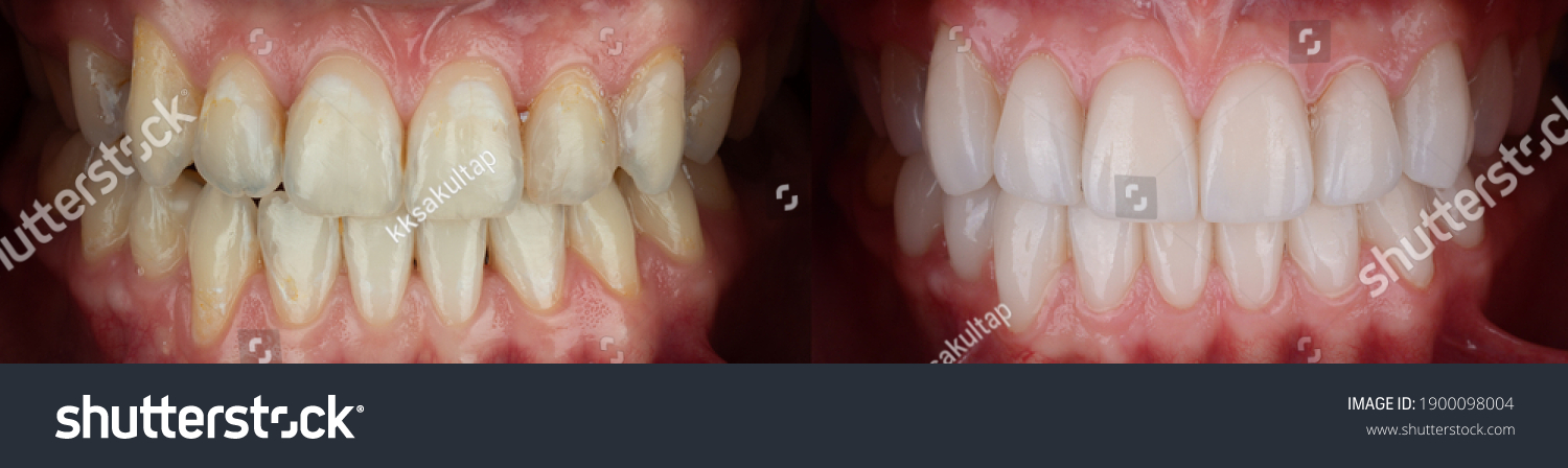Full mouth pressed ceramic veneer for smile makeover result in whiter ...