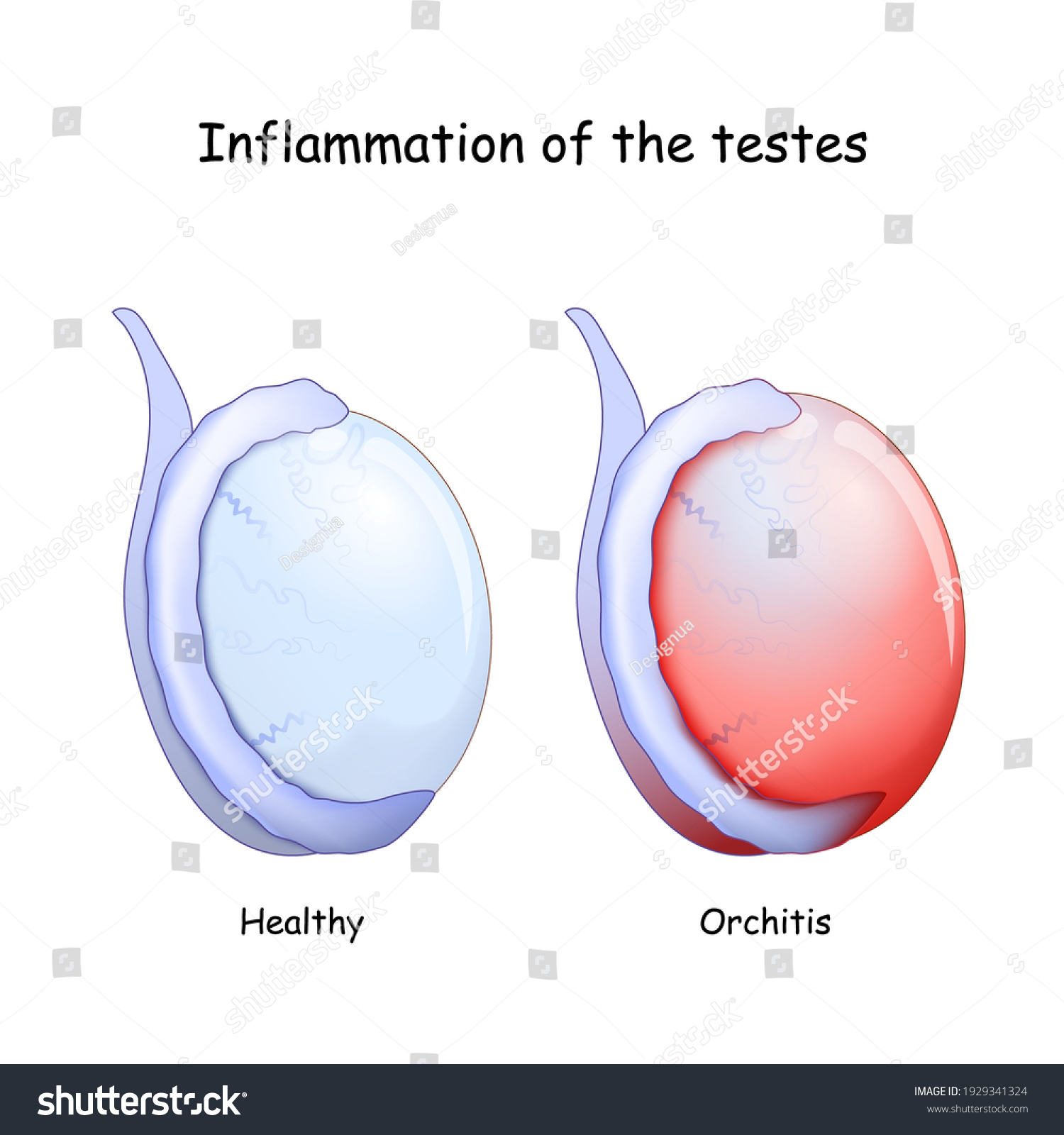 Orchitis is inflammation of the testes. comparison and difference of ...