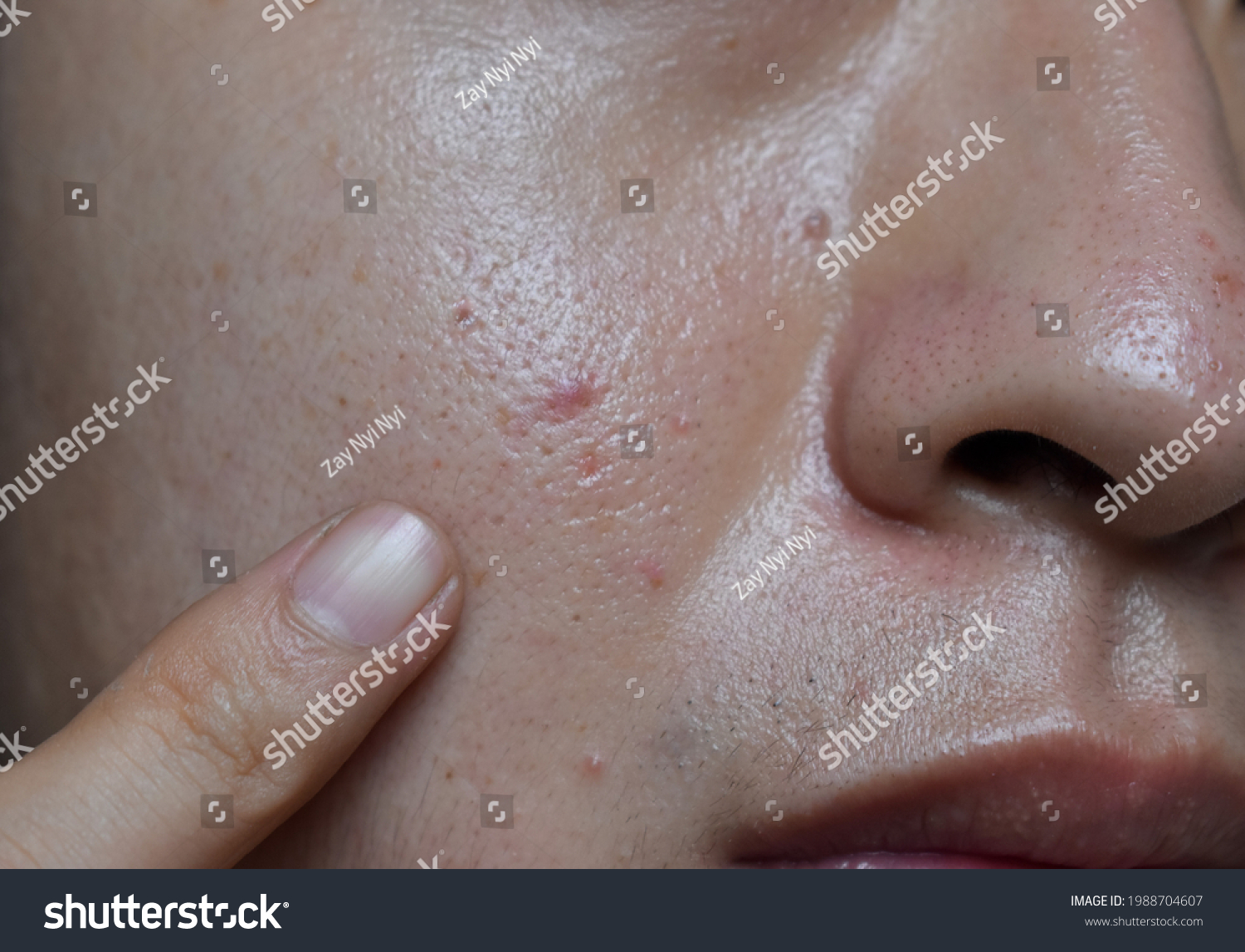 Acne vulgaris and scars on face of Southeast Asian man. Acne occurs ...