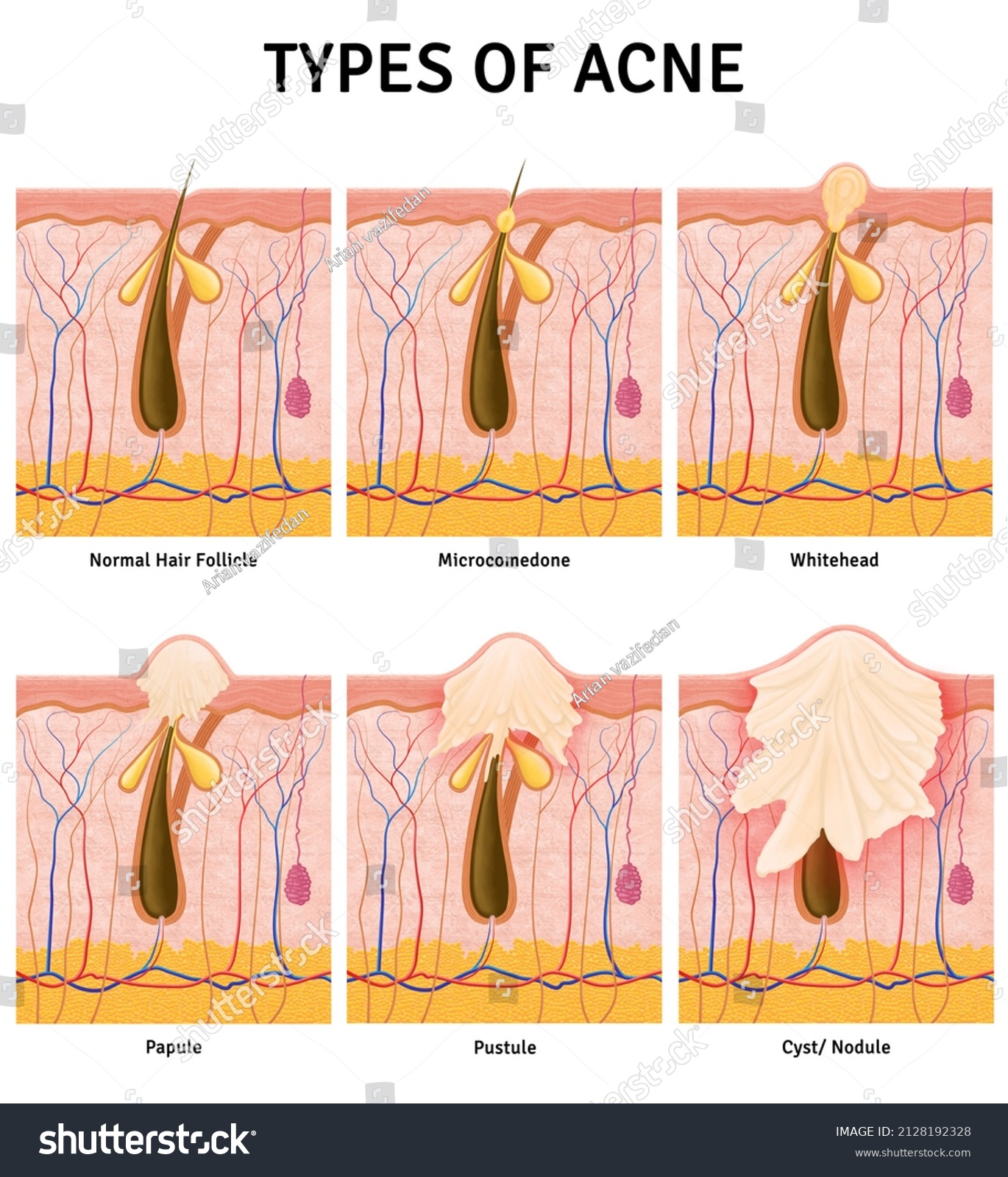 Types of acne cystic acne structure of the skin. Infographic ...