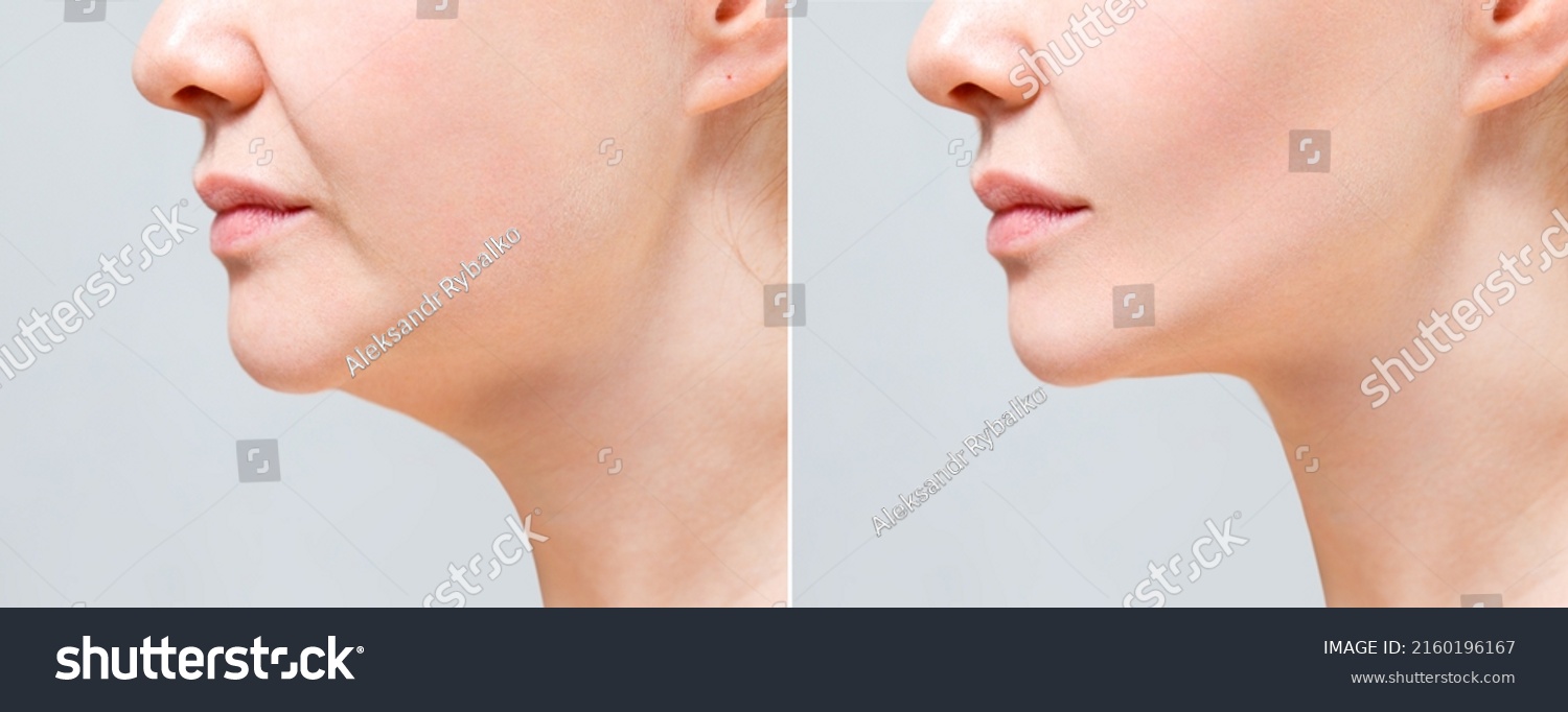 Female double chin before and after correction. Correction of the chin ...