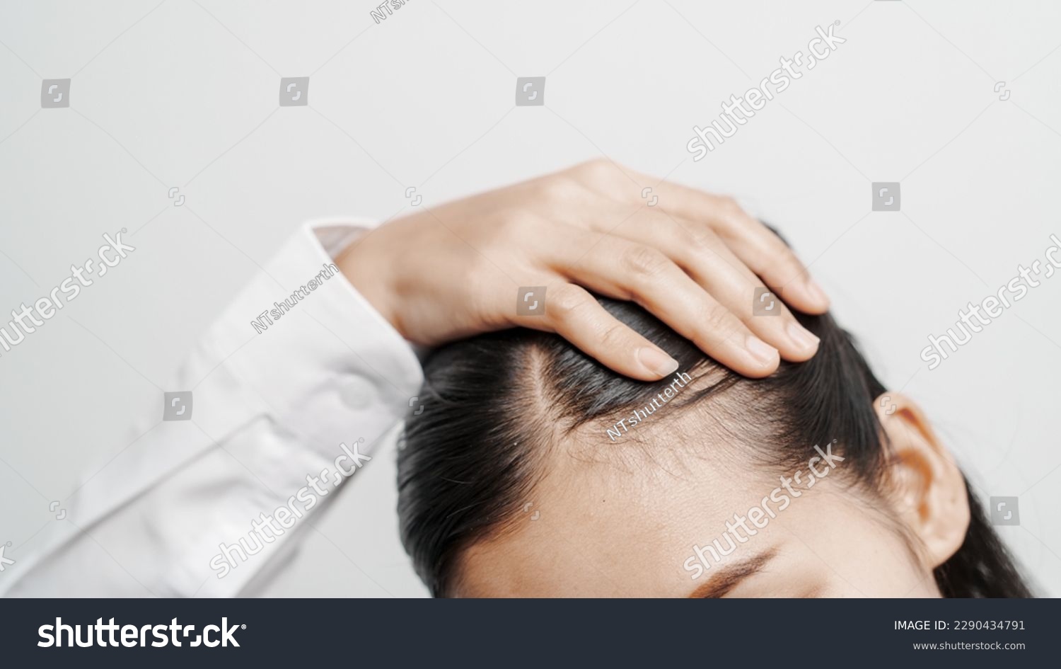 Close up young asian chinese woman with hair loss problem dandruff and ...