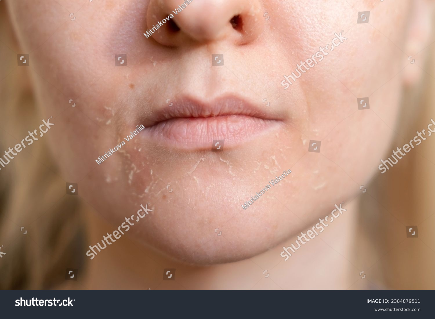 The woman skin flakes off at the mouth. Dry skin. Face skin irritation ...