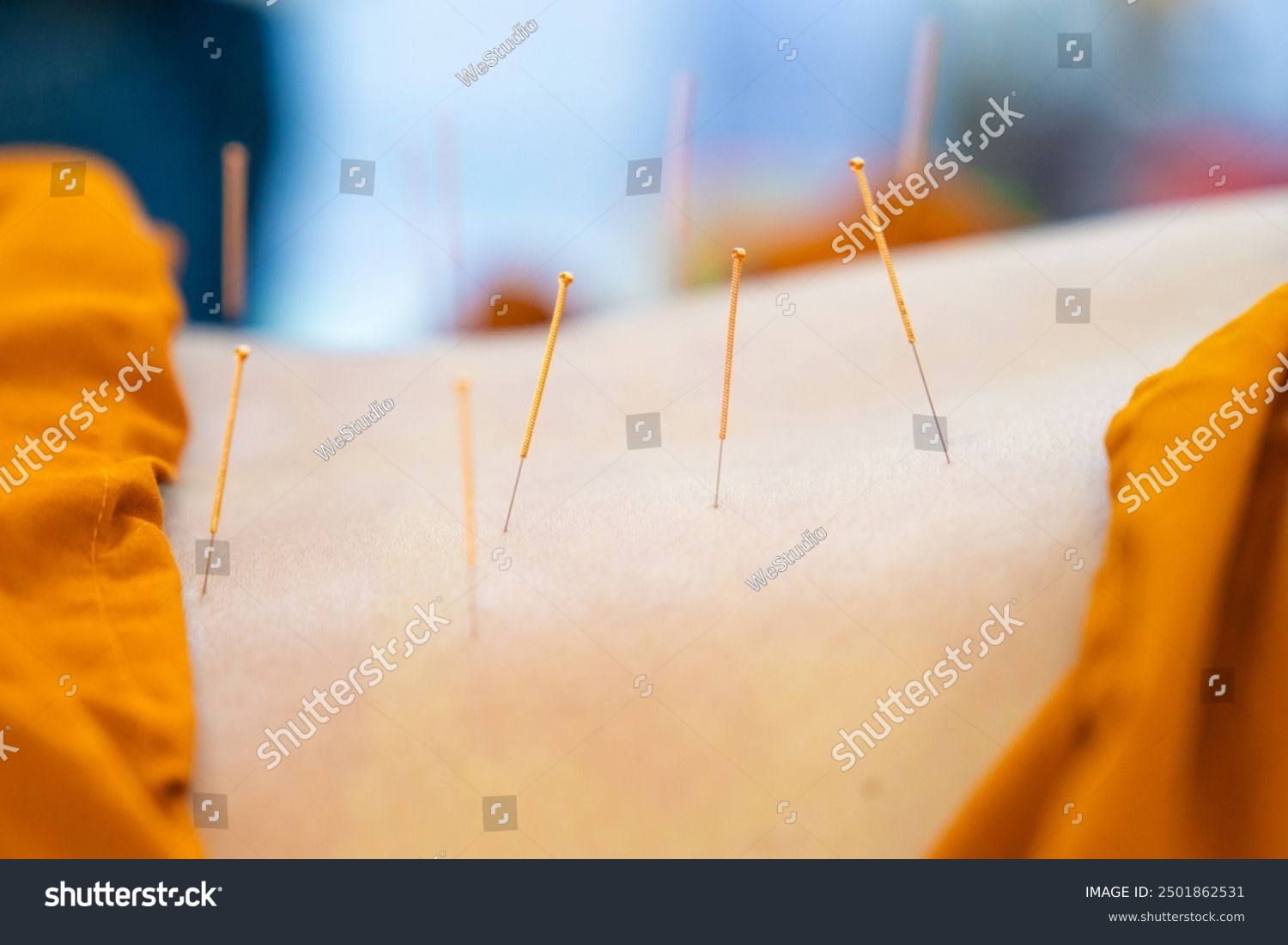 doctor sticks needles into the human body on the acupuncture ...