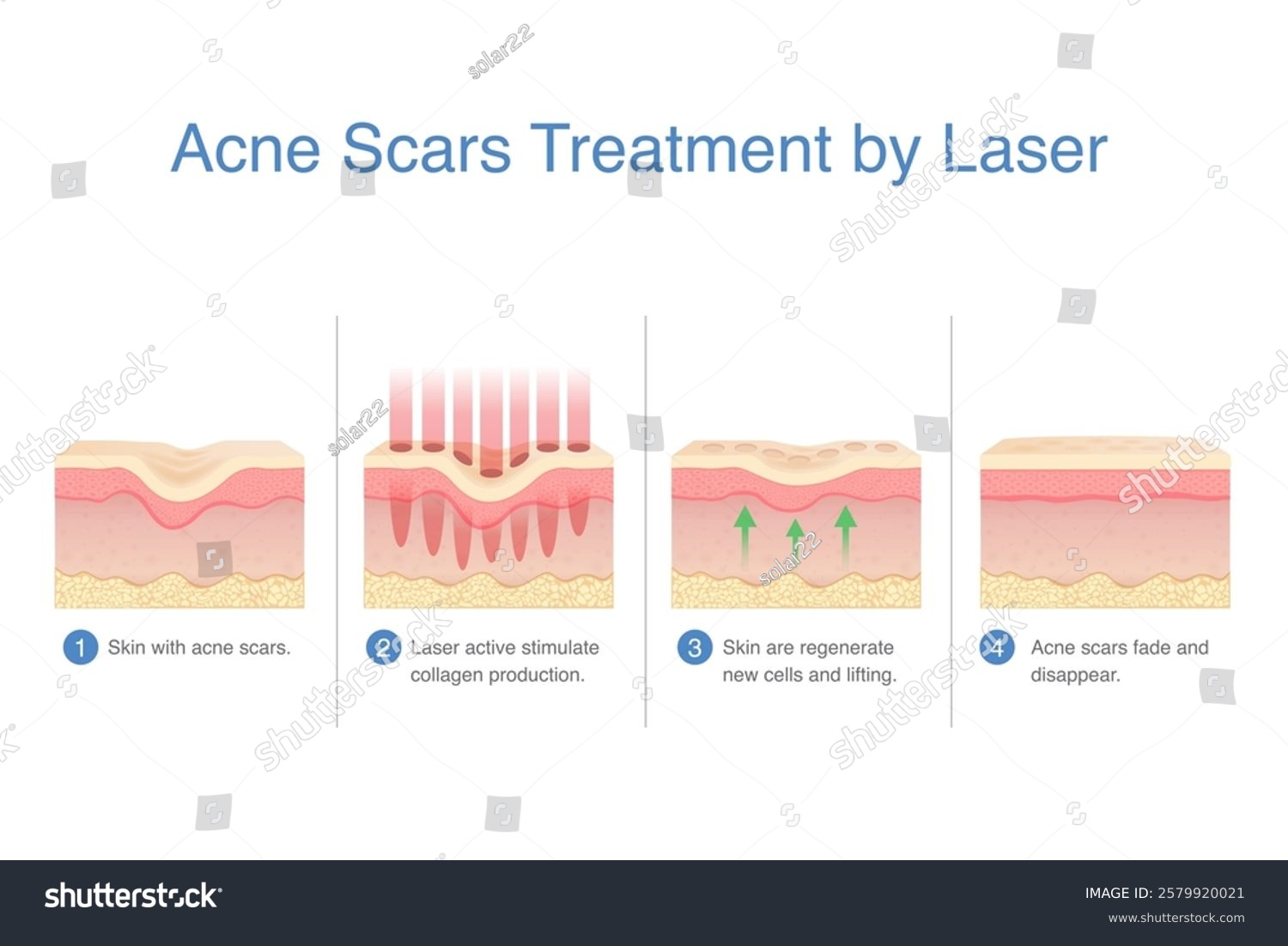 Acne scars treatment by laser. Laser active stimulate collagen ...