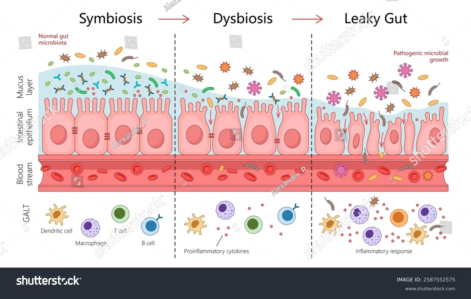gut health progression from symbiosis to dysbiosis and leaky gut showing microbiota changes ...