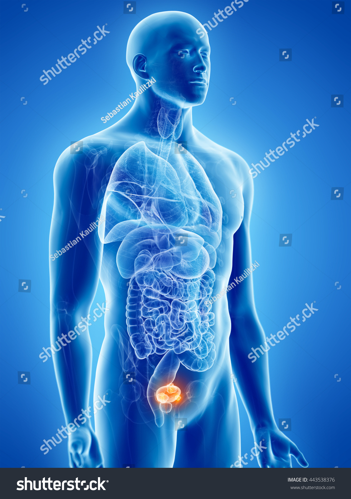 3d rendered medically accurate illustration of bladder cancer_站酷海洛_正版图片 ...
