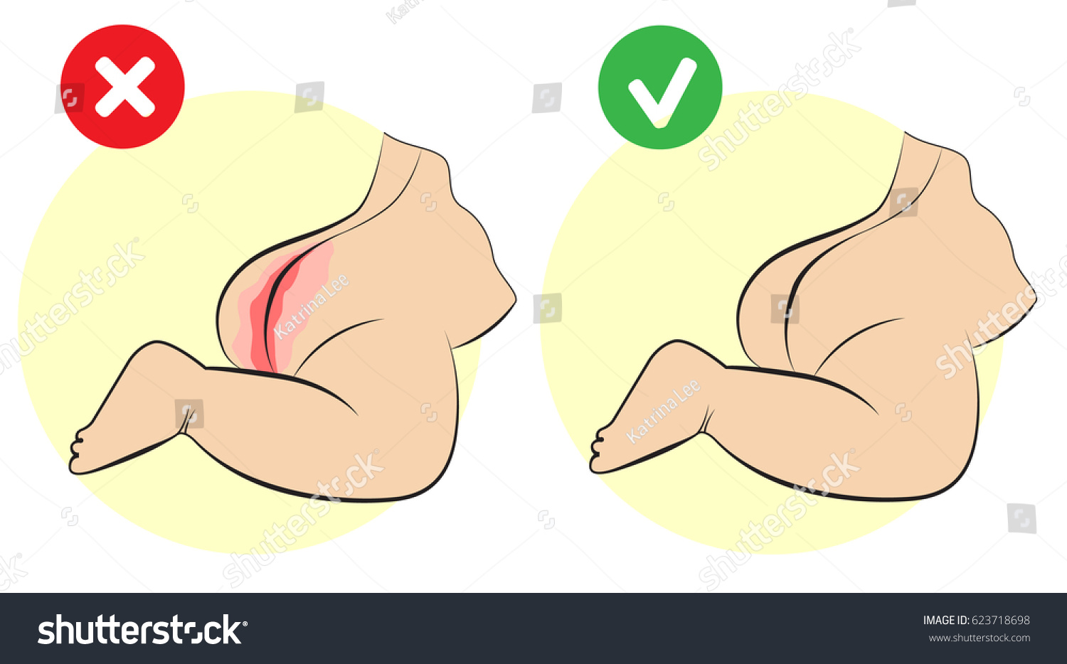 Diaper dermatitis baby. Redness on the child's bottom. The image shows ...